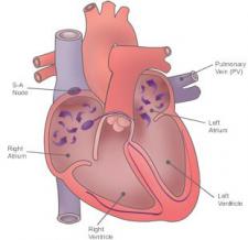 Fibrillation | Encyclopedia.com