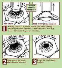 Corneal Transplantation | Encyclopedia.com