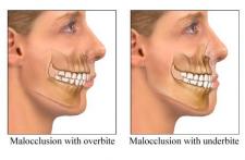 Malocclusion | Encyclopedia.com