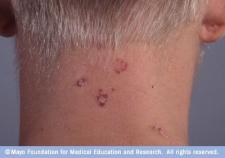 Epidermolysis Bullosa | Encyclopedia.com