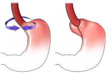 Fundoplication | Encyclopedia.com