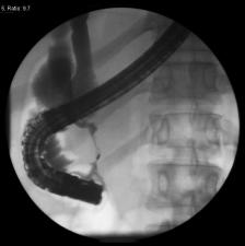 Cholangitis | Encyclopedia.com