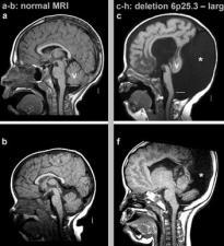 Congenital Brain Defects | Encyclopedia.com