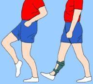 Foot Drop | Encyclopedia.com