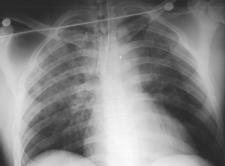 Smoke Inhalation | Encyclopedia.com