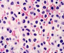 Hairy Cell Leukemia | Encyclopedia.com