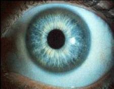 Wilsons Disease | Encyclopedia.com